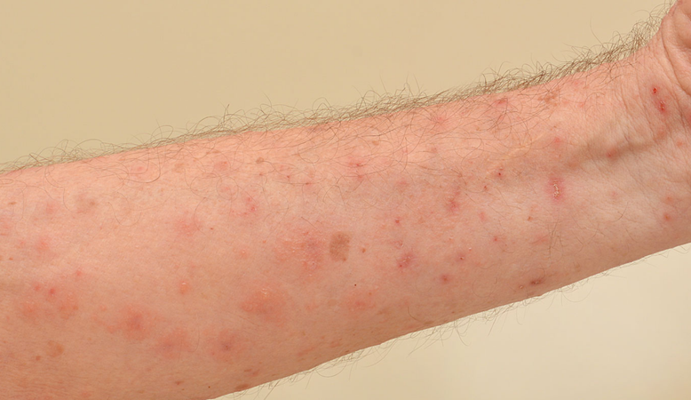 Escabiose: como descobrir e tratar a sarna humana? - Dia a Dia Nordeste